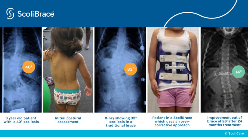 ScoliBrace | Core Posture Chiropractor Newport Beach