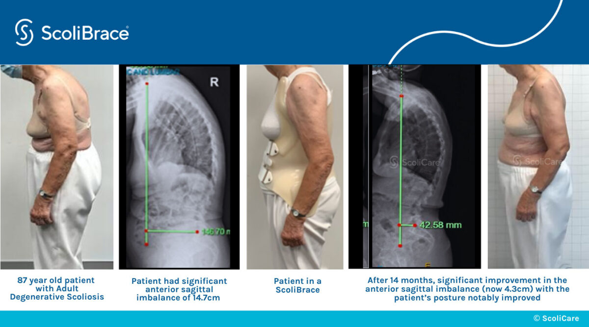 ScoliBrace | Core Posture Chiropractor Newport Beach