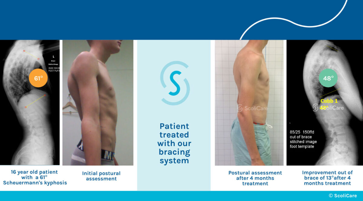 ScoliBrace | Core Posture Chiropractor Newport Beach